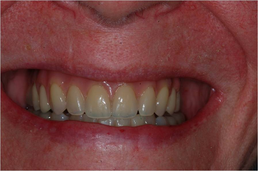 Implant Case - Private Dentistry