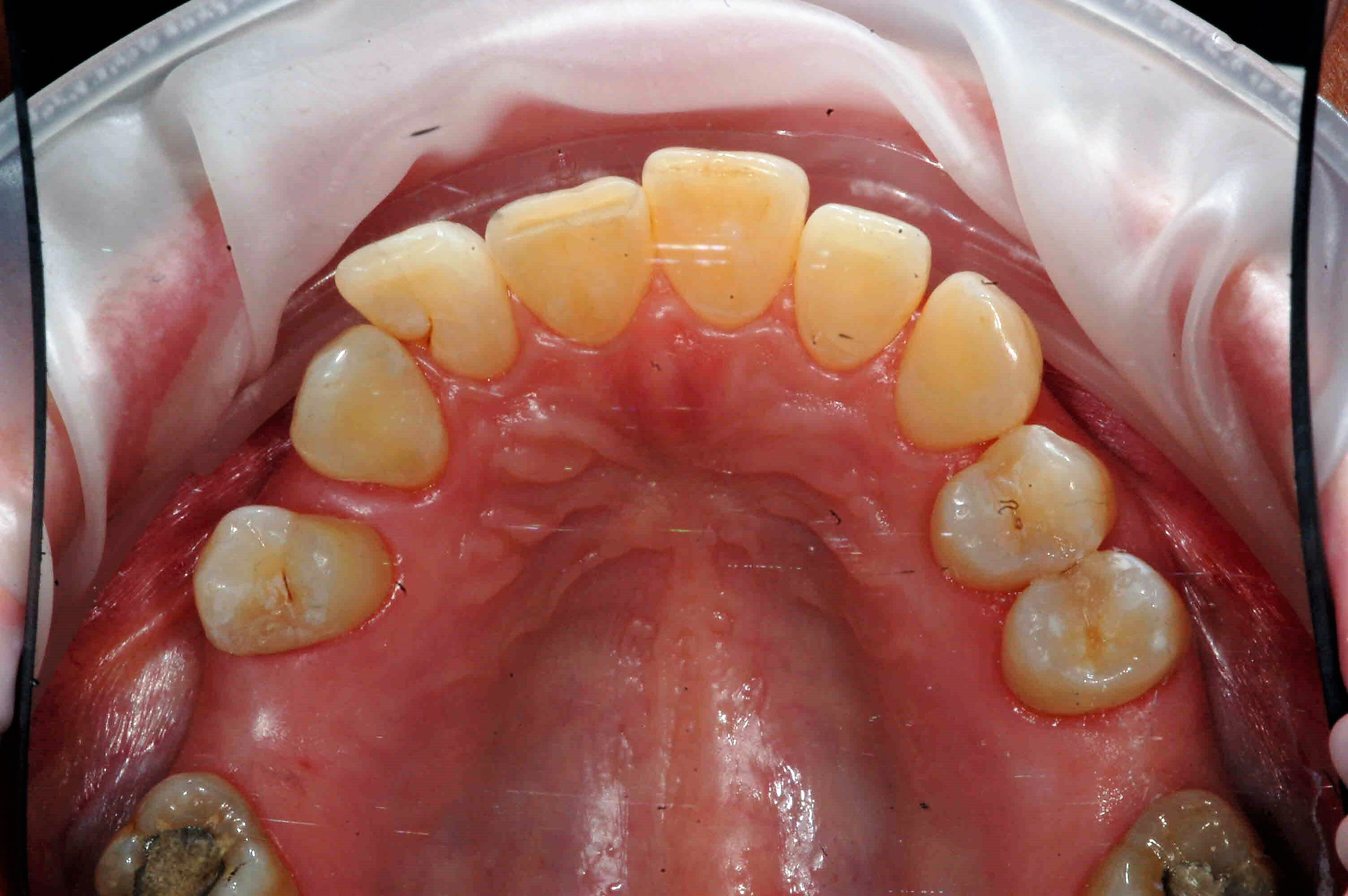 Upper Pre Op l - Private Dentistry