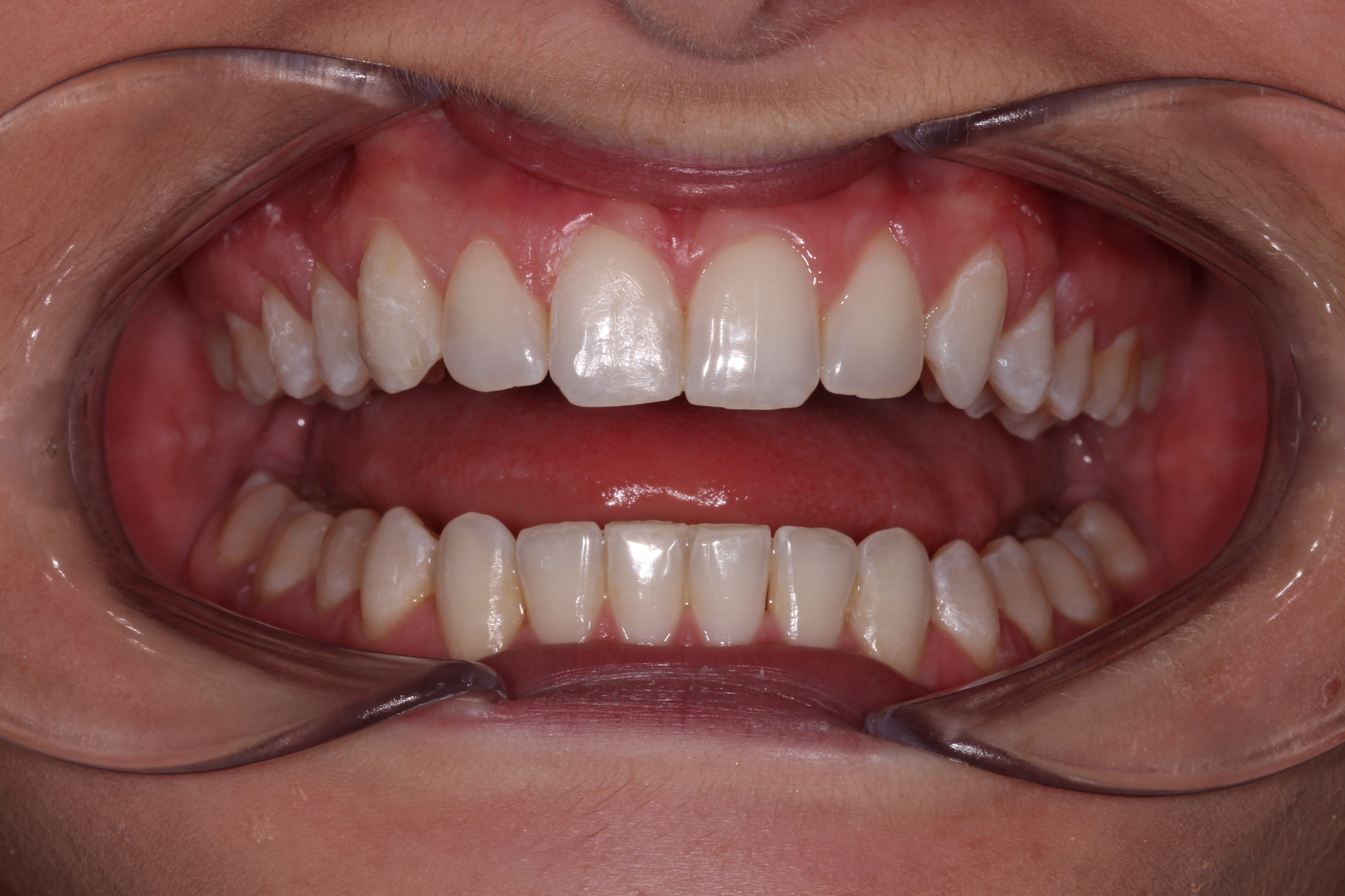 Invisalign - Private Dentistry