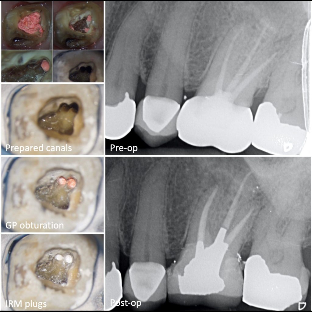 Endo Case 4 - Private Dentistry