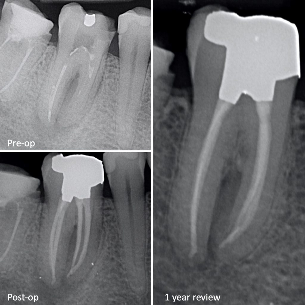 Endo case 3 - Private Dentistry