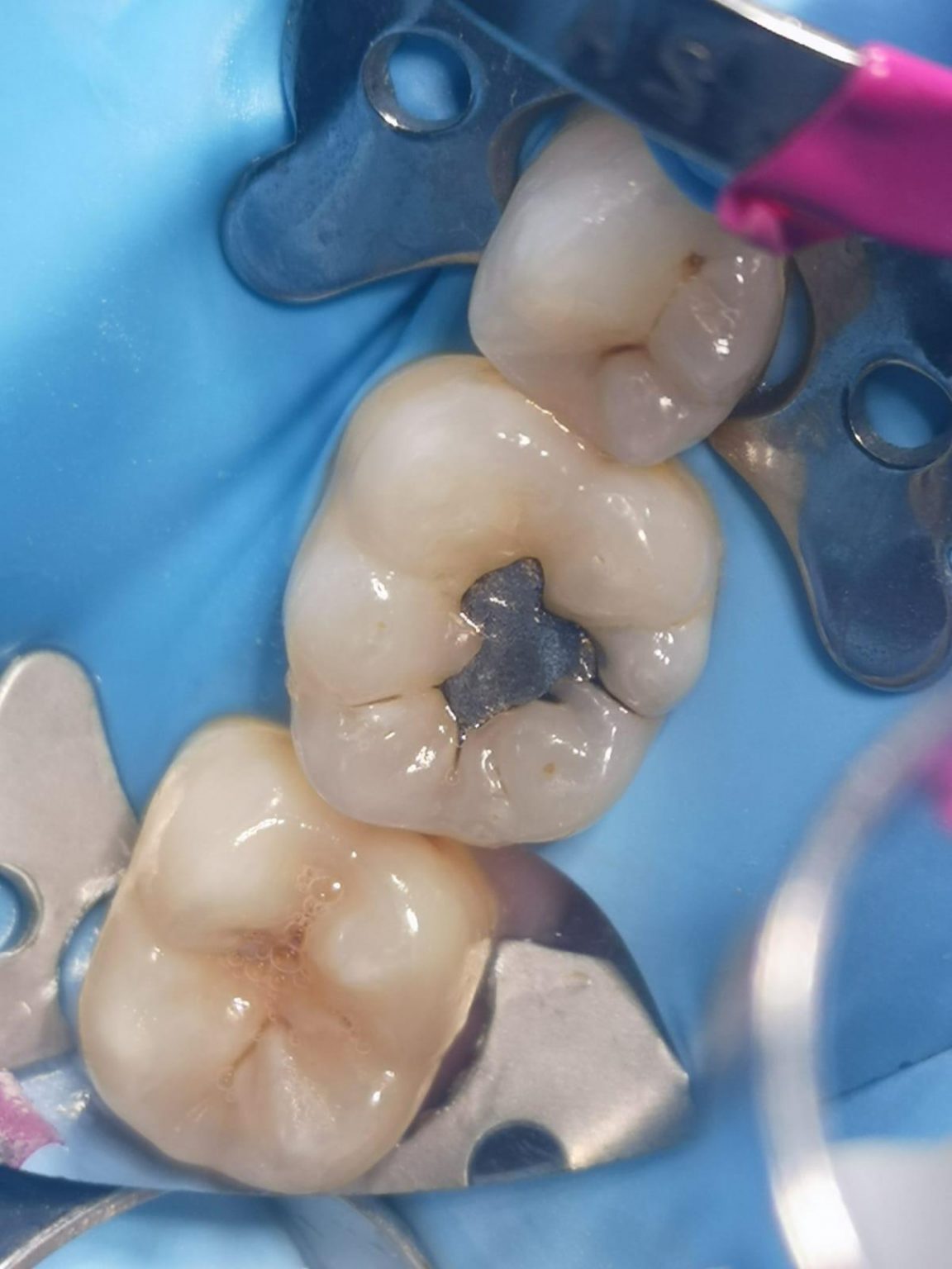 Amalgam filling replacement with composite - Private Dentistry