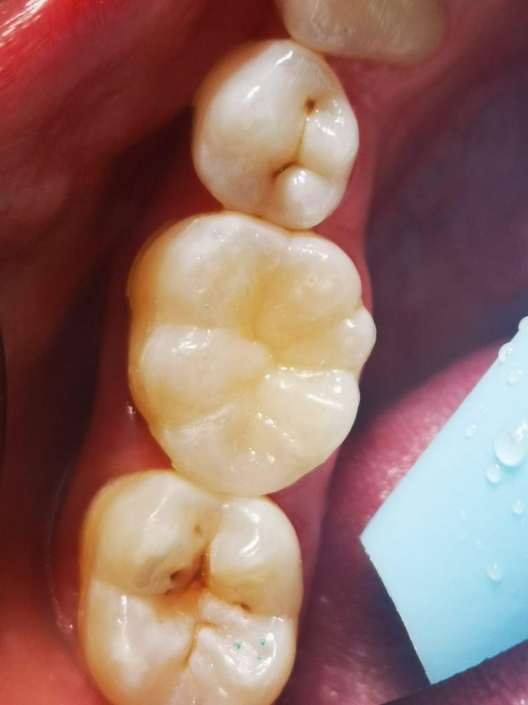 Amalgam filling replacement with composite - Private Dentistry