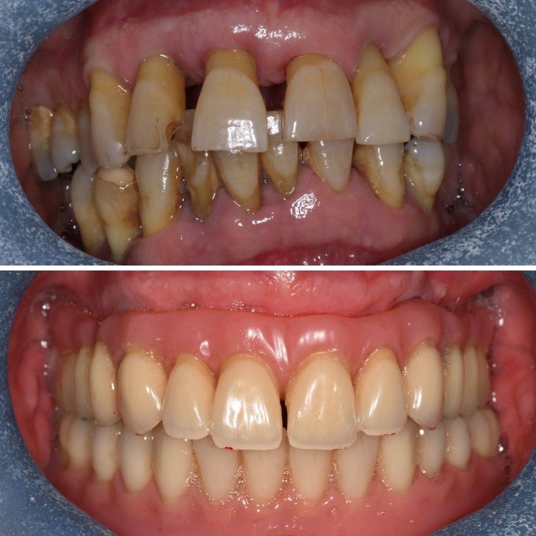Upper and Lower Arch Implant Solution - By Finley Bason - Private Dentistry