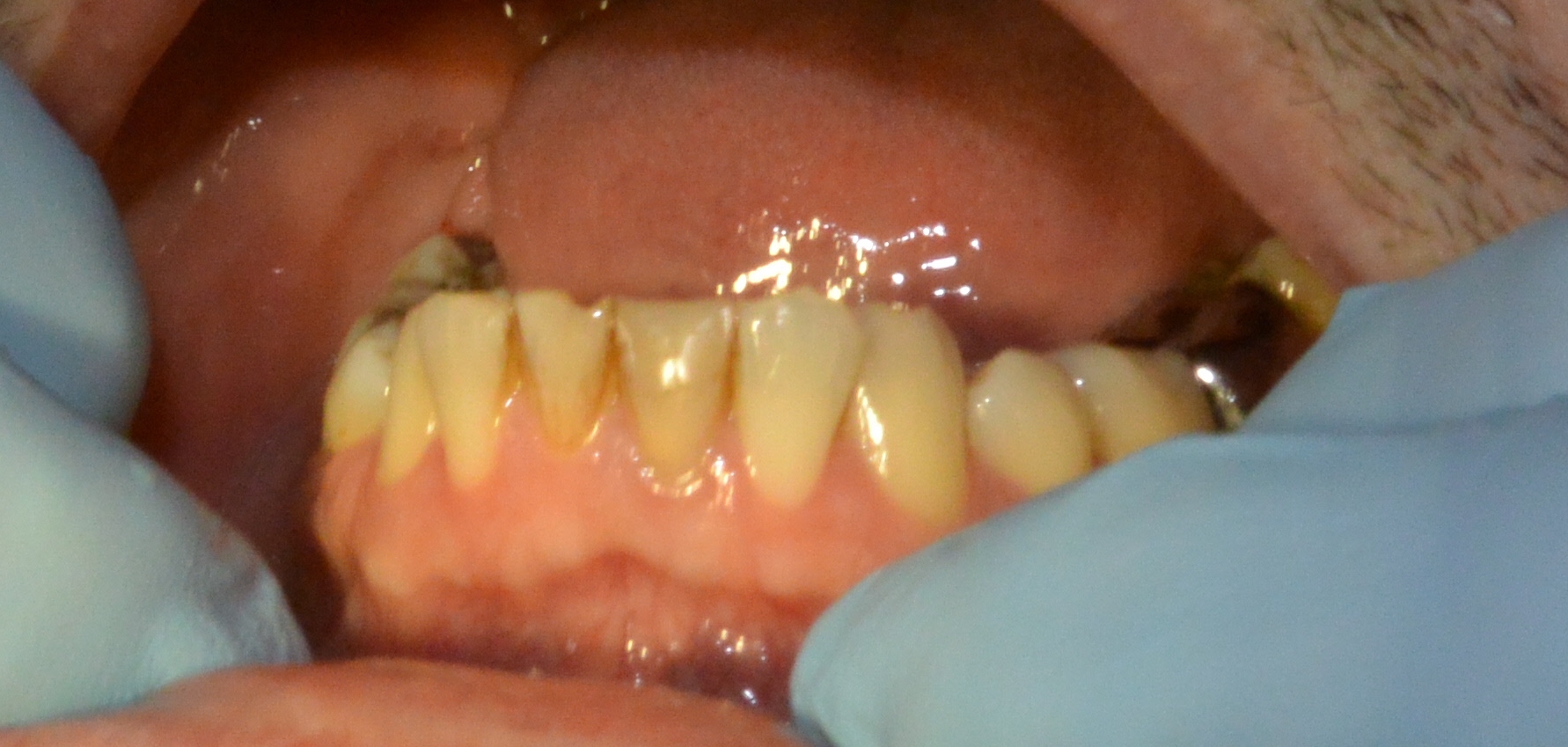 Teeth - Carriage Works Dental