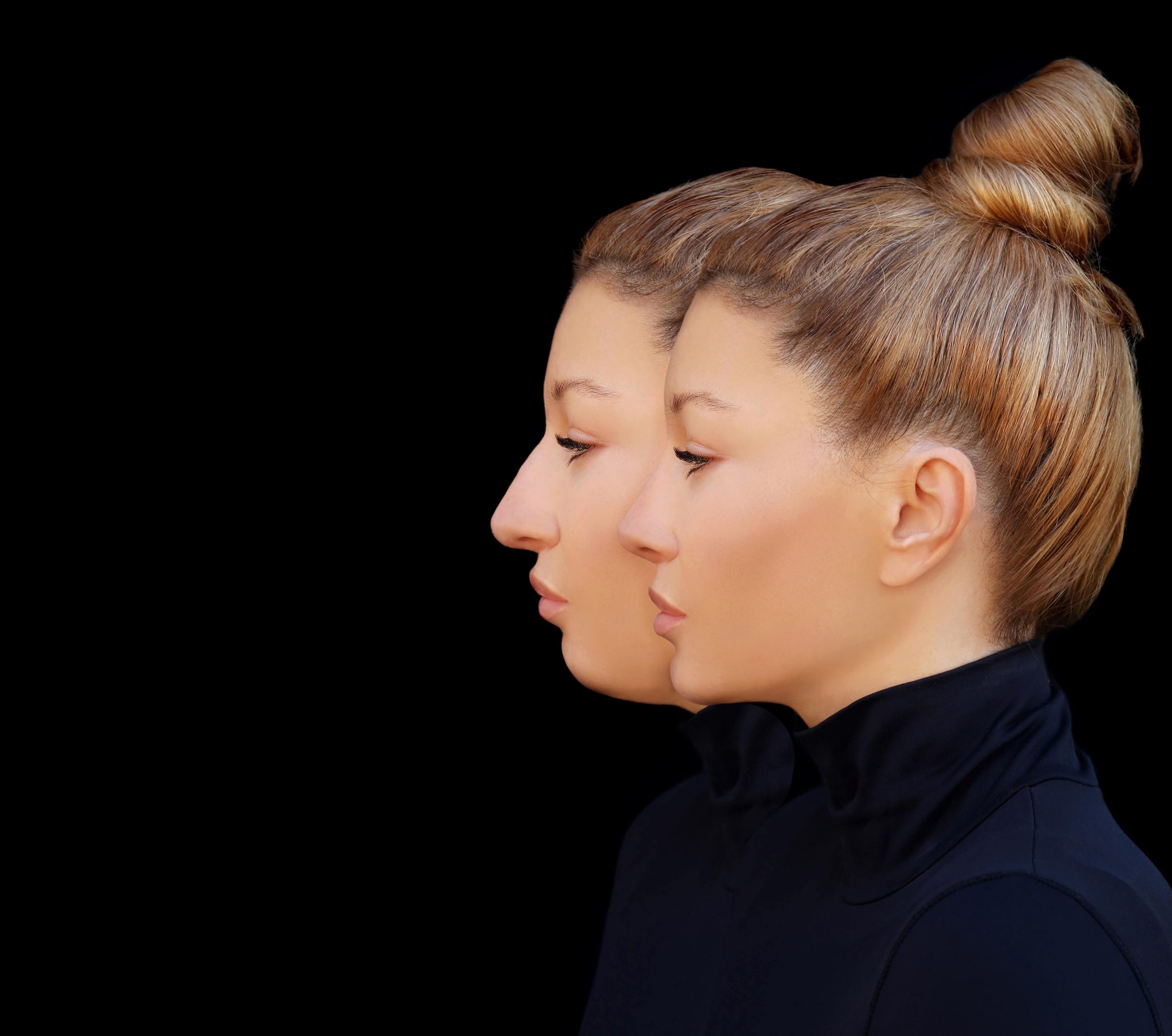 Chin Augmentation - Carriage Works Dental